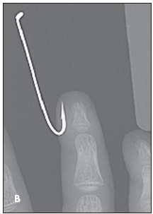 Photoclinic: Hooked Finger | Consultant360