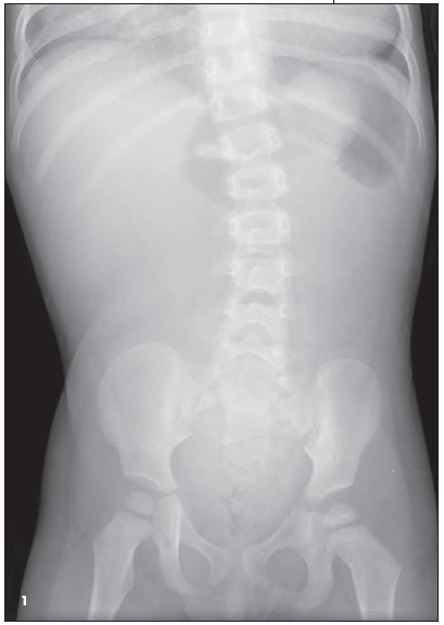 Repeated Episodes of Abdominal Pain Followed by Emesis in a 22-Month ...