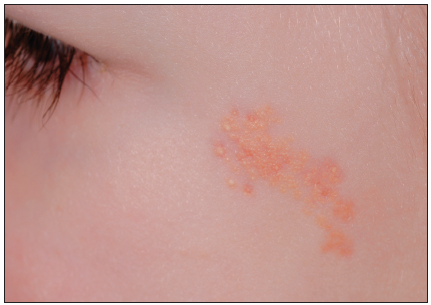 Does this yellow-brown plaque on a young girl's cheek require removal ...