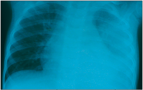 Pneumonia in Children: Update on Causes—and Treatment Options ...