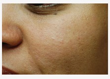 What underlies this persistent facial rash? | Consultant360