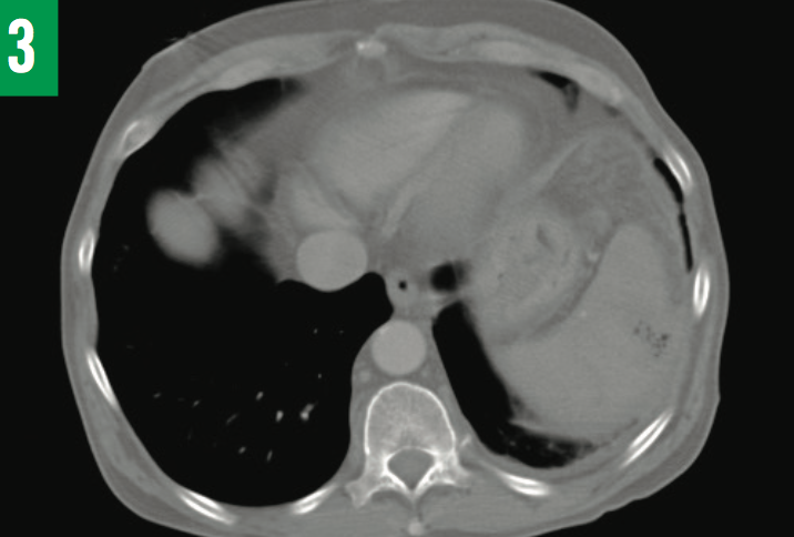Splenic Abscess Due to Salmonellosis | Consultant360