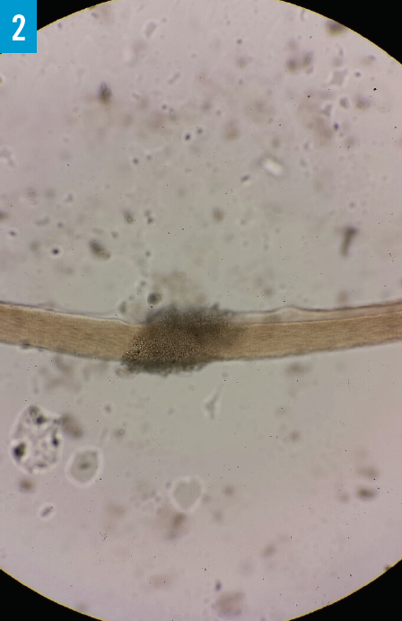 Hair Breakage and Spontaneous Hair Loss in 2 Sailors Aboard an Aircraft ...