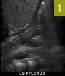 Infantile Hypertrophic Pyloric Stenosis | Consultant360