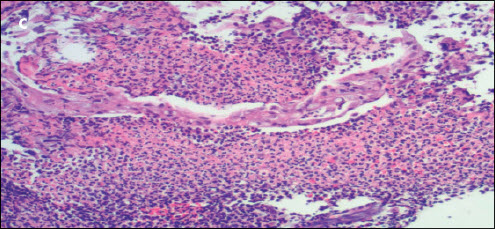 Apple Core Lesion | Consultant360