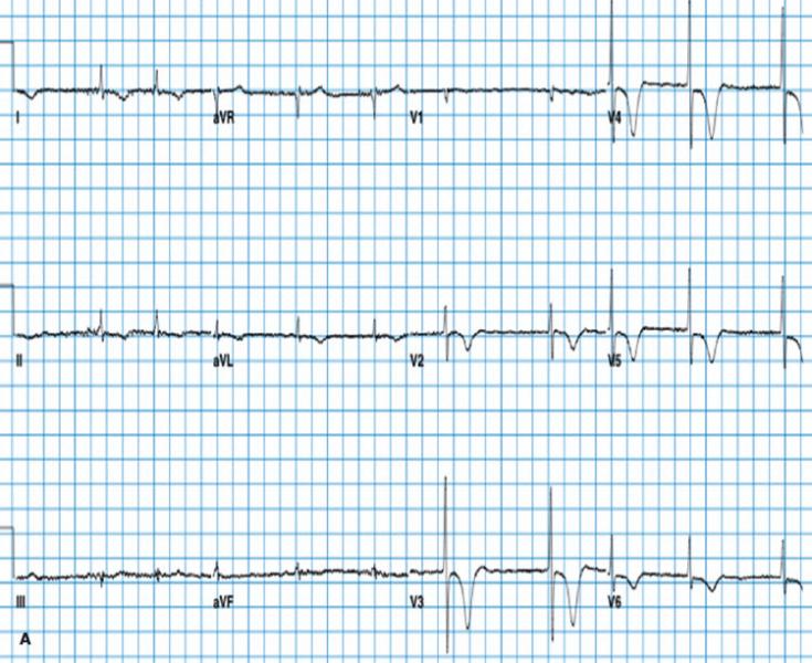 Wellens Syndrome | Consultant360