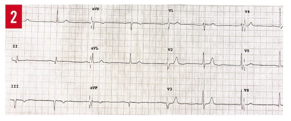 A Man’s Sudden Cardiac Arrest: A Case of Brugada Syndrome | Consultant360