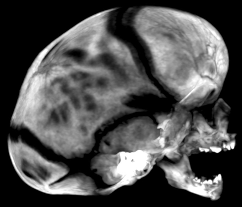 Sagittal Craniosynostosis With Scaphocephaly | Consultant360