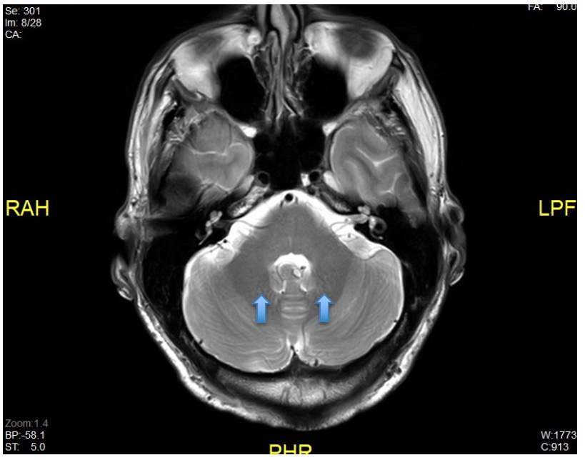 Acute Ataxia Following Cerebral Abscess on Long-Term Antibiotic Therapy ...