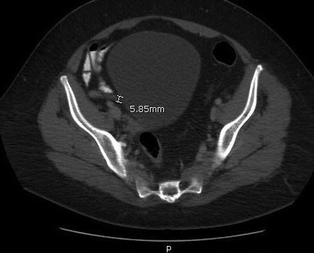 Atypical Appendicitis Preceded by Viral Illness | Consultant360