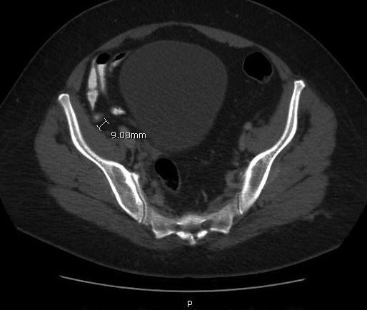 Atypical Appendicitis Preceded by Viral Illness | Consultant360