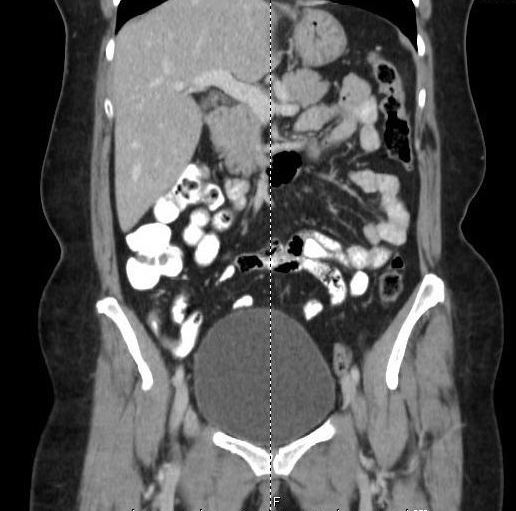 Atypical Appendicitis Preceded by Viral Illness | Consultant360