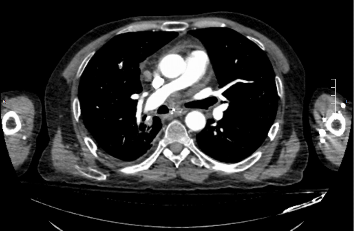 Cardiac Tamponade: A Rare Presentation of Non-Small Cell Lung Cancer ...