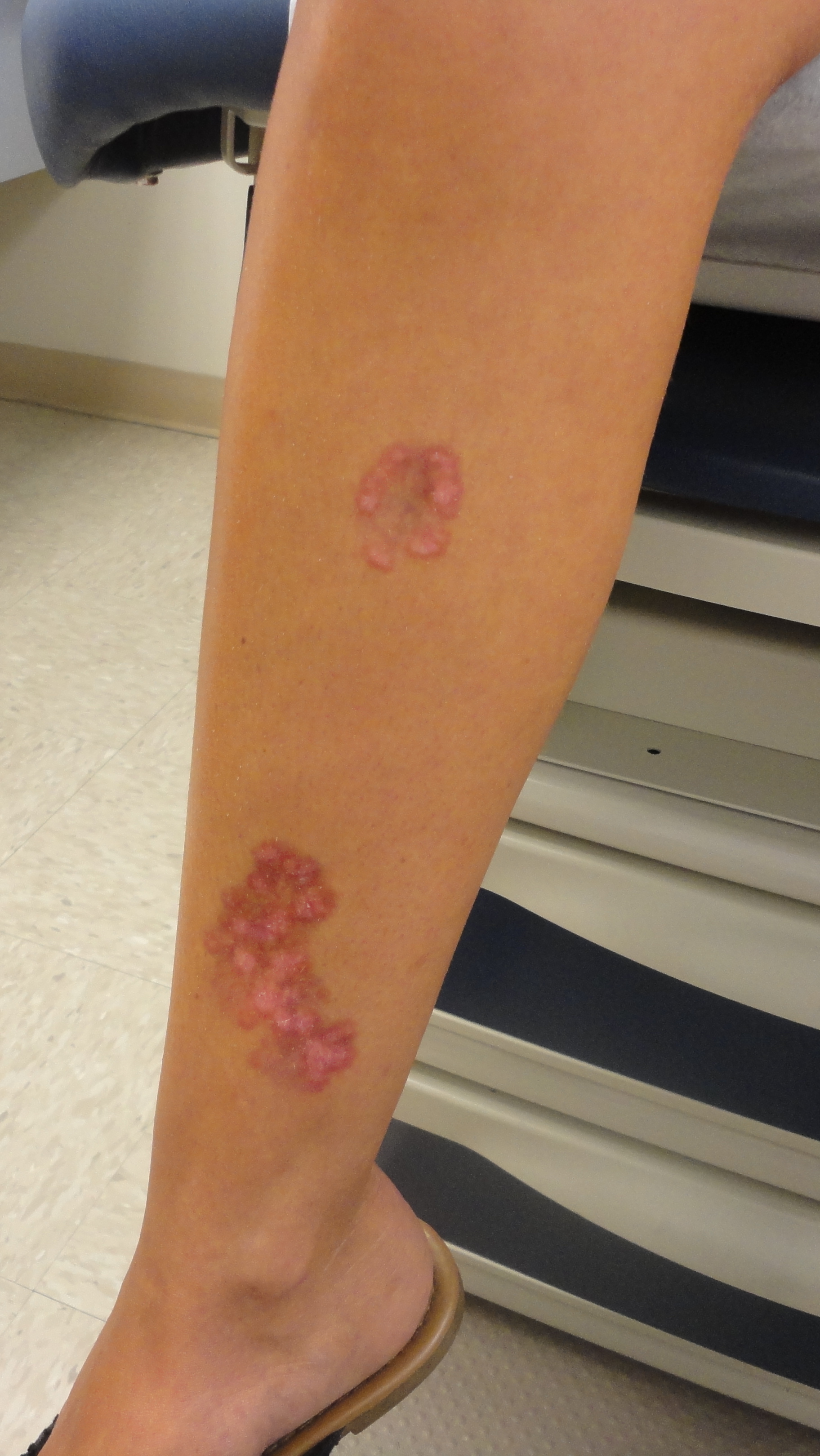 A Woman With Lobular Plaques on Her Shin | Consultant360
