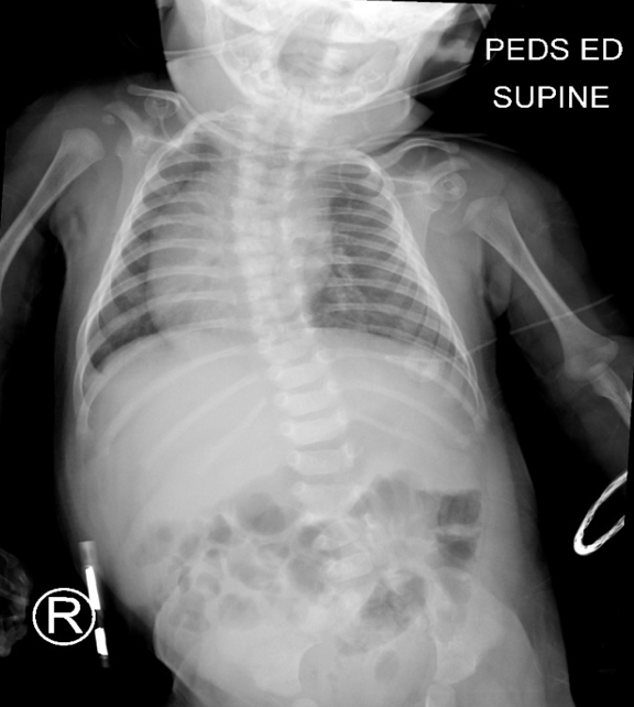 VACTERL Association | Consultant360