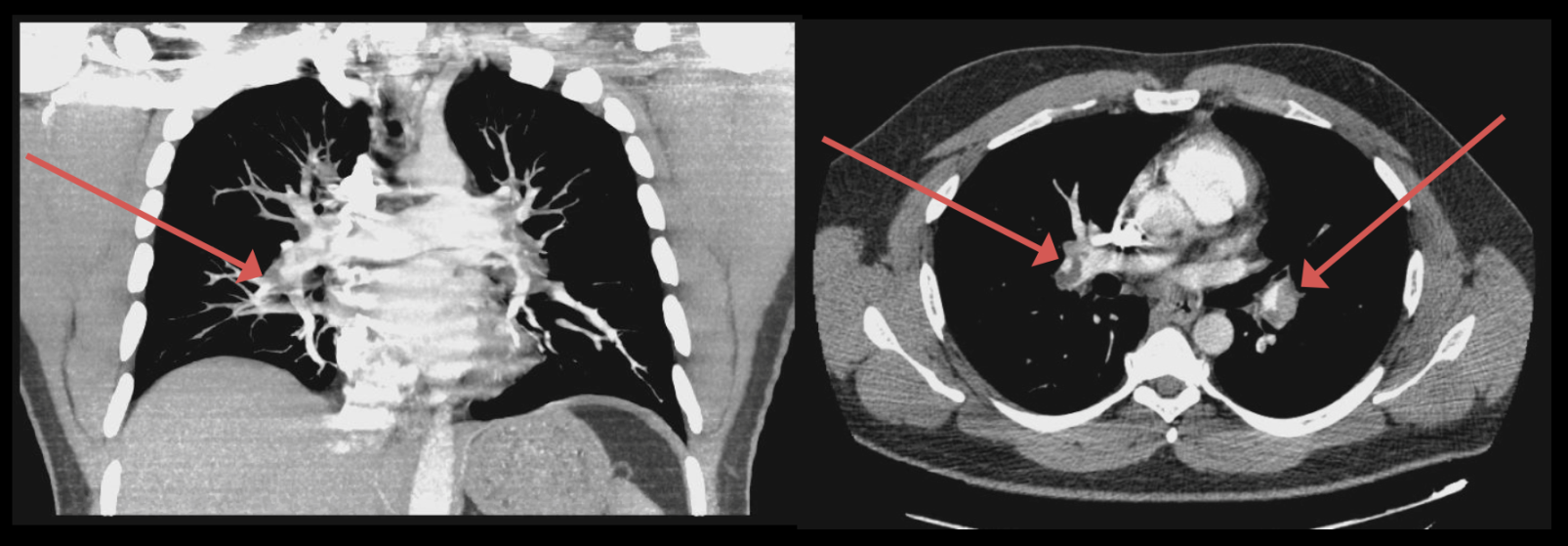 Deep-Vein Thrombosis and Pulmonary Embolism From Binge Gaming ...