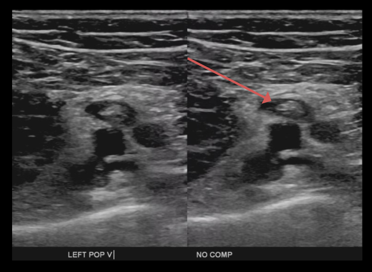 Deep-Vein Thrombosis and Pulmonary Embolism From Binge Gaming ...