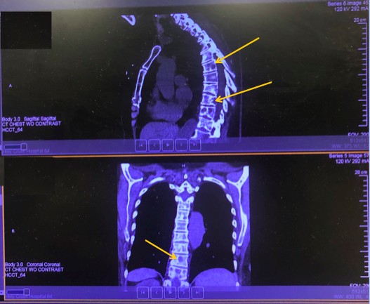 Extreme Hypercalcemia of Malignancy | Consultant360