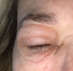 Parvovirus B19 Infection | Consultant360