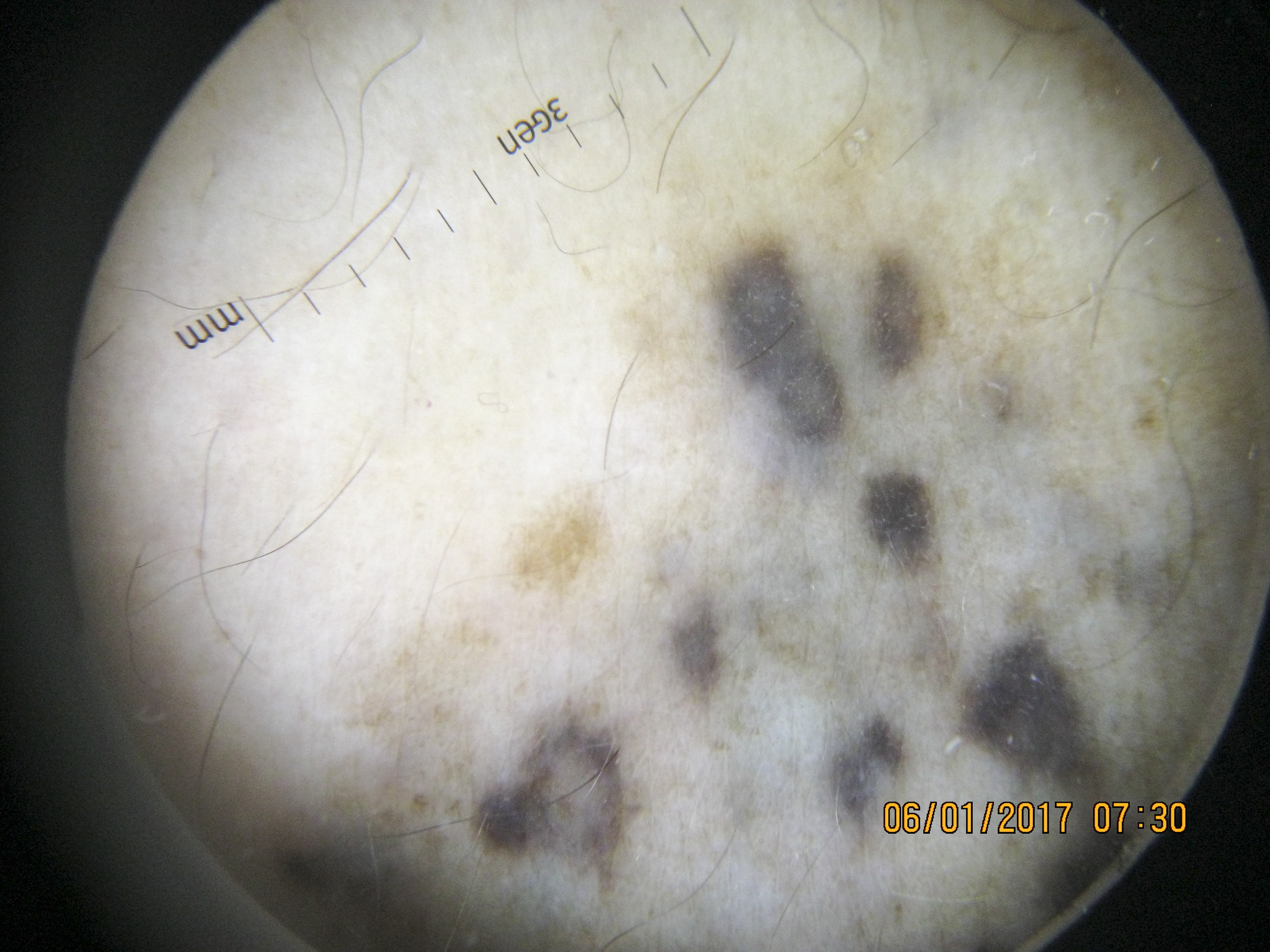 Agminated Blue Nevus Arising in a Nevus Spilus | Consultant360