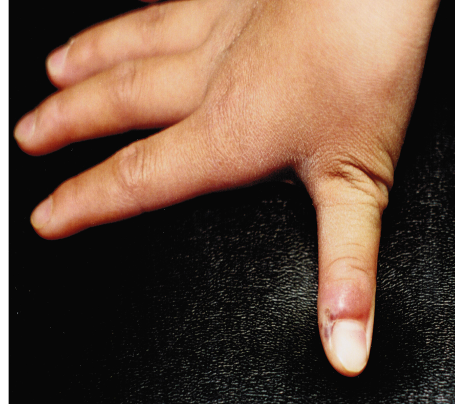 An Atlas of Nail Disorders, Part 1 | Consultant360