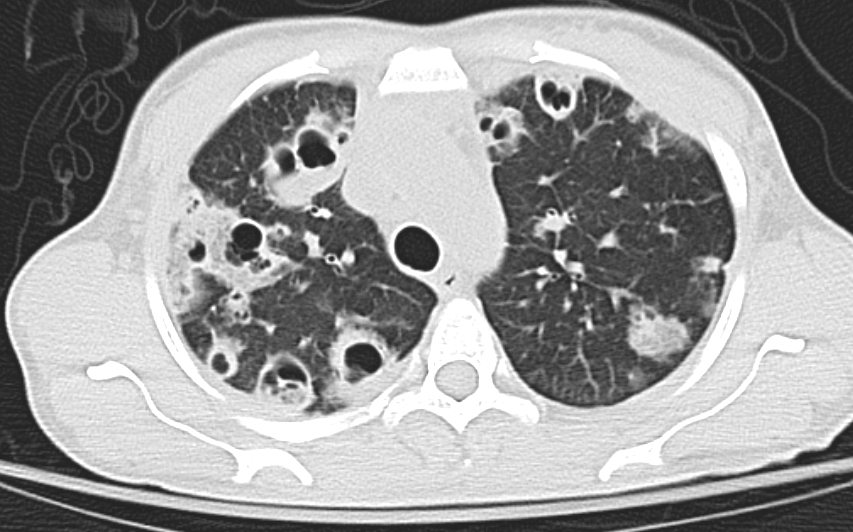 What Is the Cause of These Lung Lesions? | Consultant360
