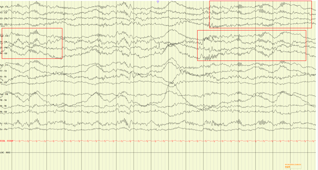 A 15-Year-Old Girl With Anti-NMDA Encephalitis With Extreme Delta Brush ...