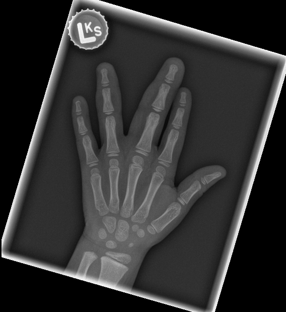 Isolated Macrodactyly | Consultant360