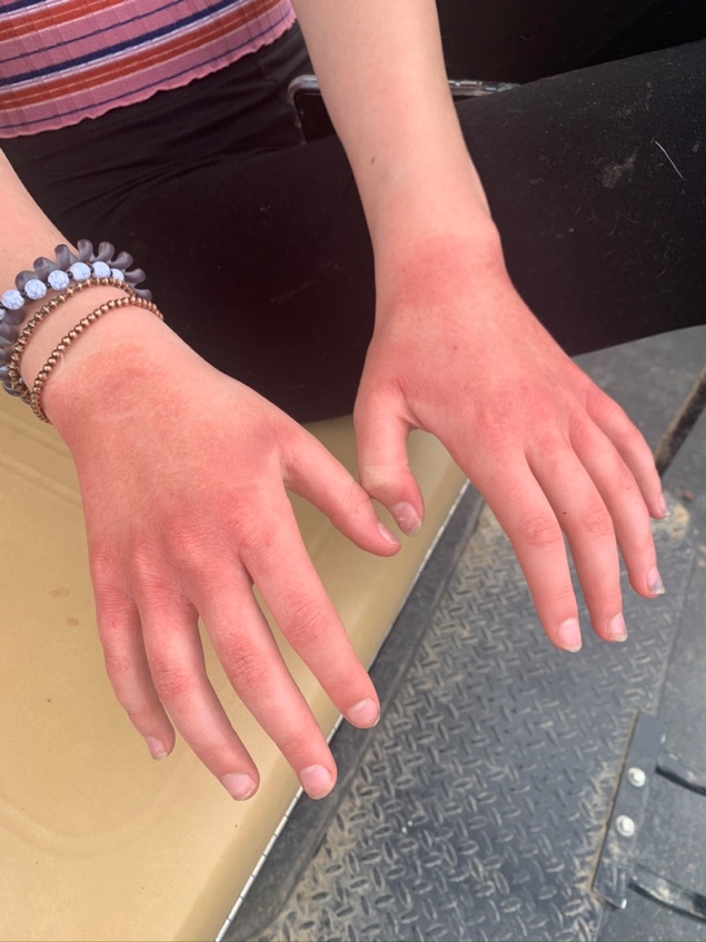 Irritant Contact Dermatitis Hand Irritant Contact Dermatitis Hand