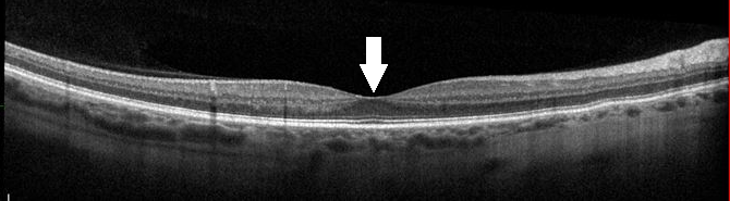 Retinal Vein Occlusions: Diagnosis and Management | Consultant360