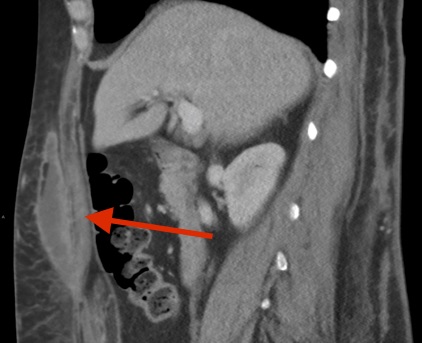 Mycobacterium abscessus Surgical Wound Infection Following ...