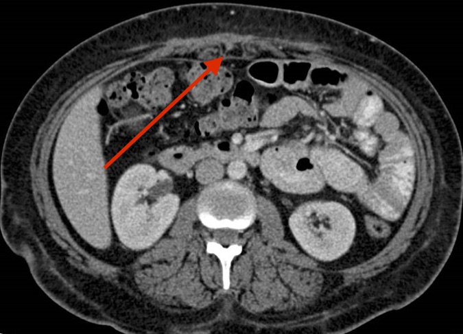 Mycobacterium abscessus Surgical Wound Infection Following ...