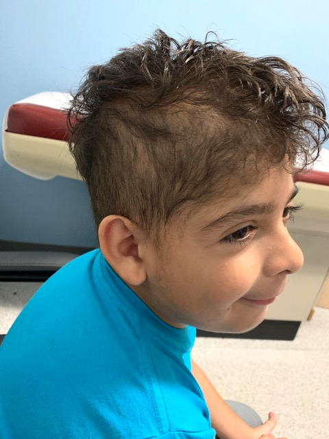 Nicolaides-Baraitser Syndrome | Consultant360