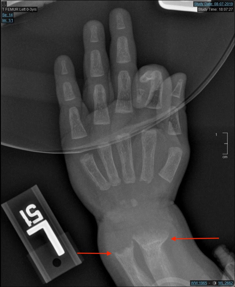 Rickets Presenting as Hypocalcemic Seizures in the Setting of a Febrile ...