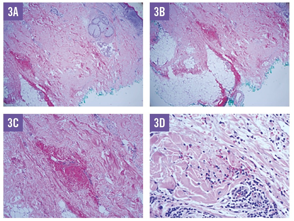 Asymptomatic Rash With Unusual Hair Shaft Deformities: A Case of Scurvy ...
