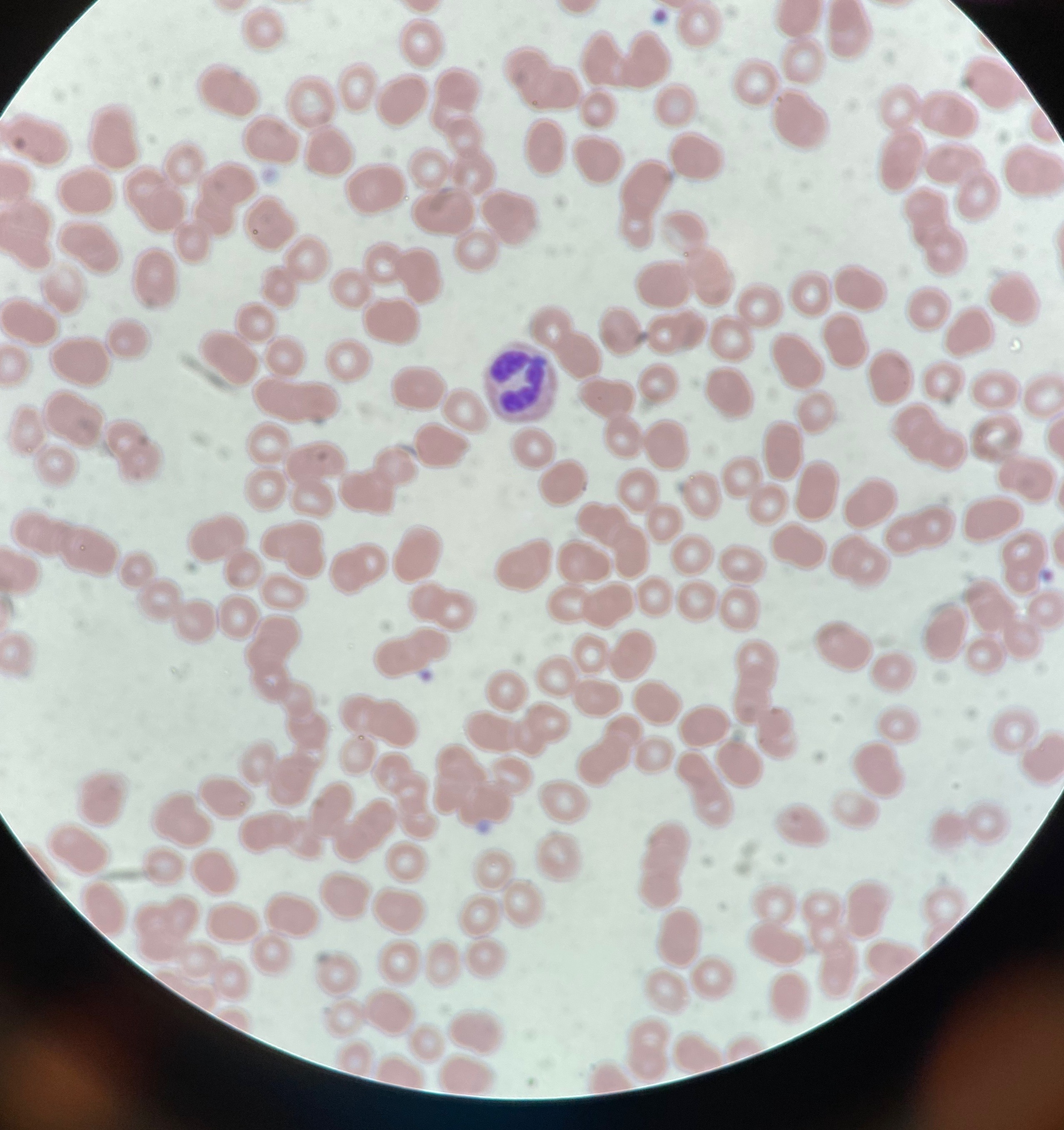 A Case of Anaplasmosis During the COVID-19 Pandemic | Consultant360