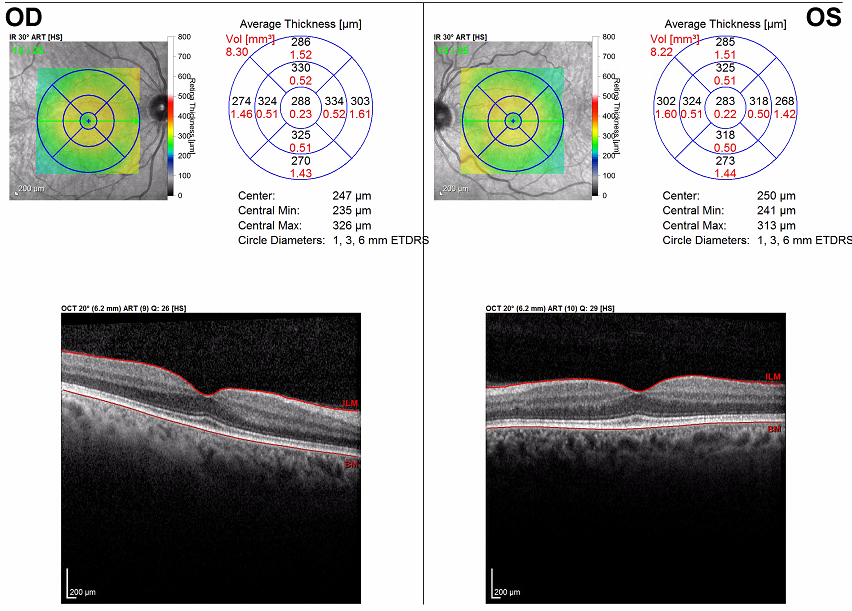 Bilateral Serous Epithelial Detachment After Starting Therapy With ...