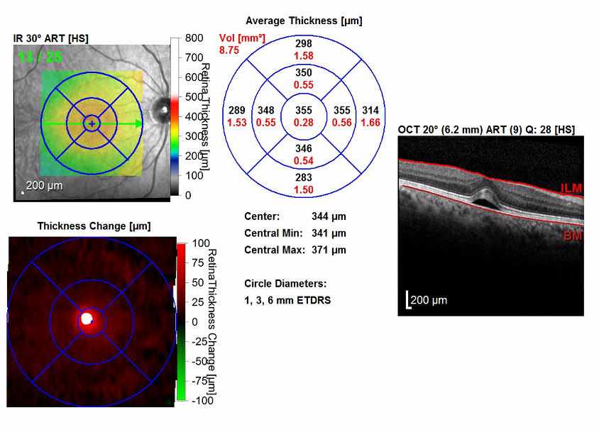 Bilateral Serous Epithelial Detachment After Starting Therapy With ...