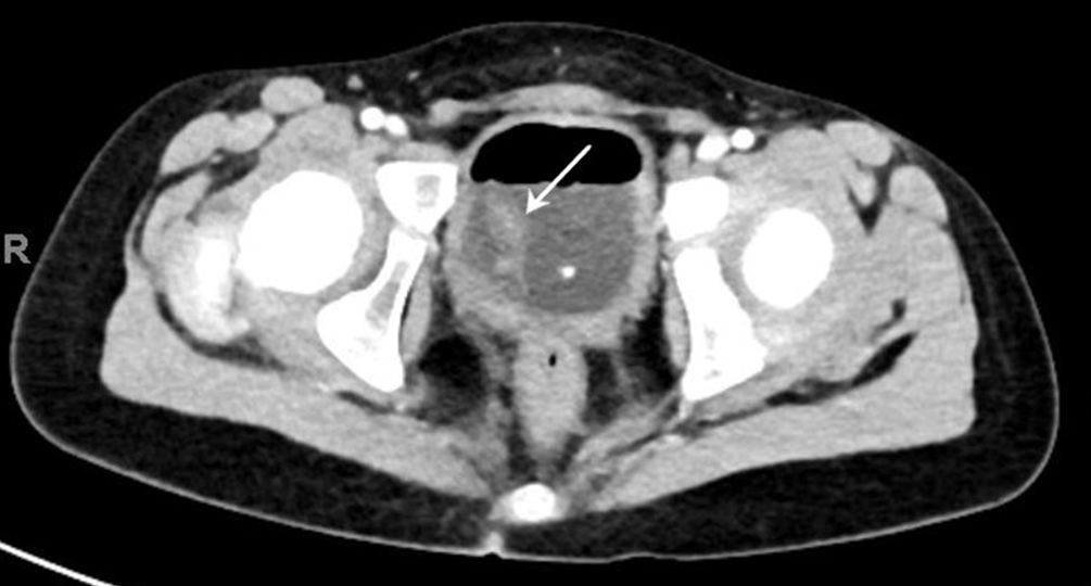 Fibroepithelial Polyp: An Unusual Cause of Acute Urinary Retention in a ...