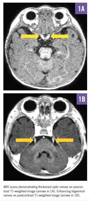Krabbe Disease | Consultant360