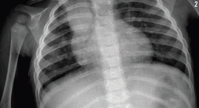 Comparing Prior Radiographs Aids in the Diagnosis of Bronchiectasis ...