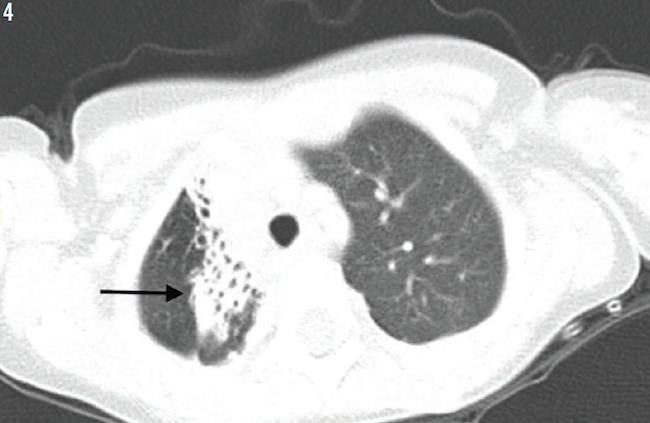 Comparing Prior Radiographs Aids in the Diagnosis of Bronchiectasis ...