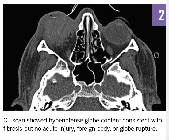 Traumatic Hemorrhagic Chemosis | Consultant360