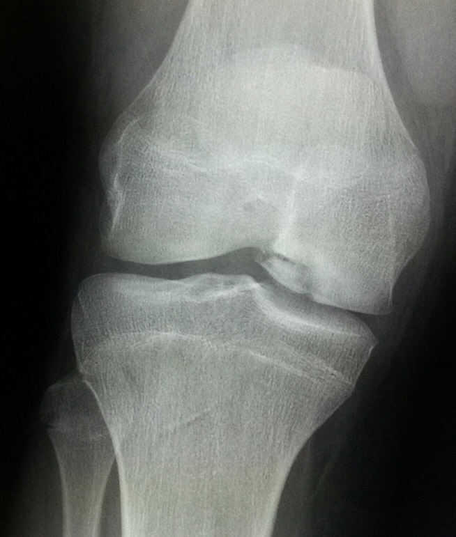 An 18-Year-Old With Right Knee Pain | Consultant360