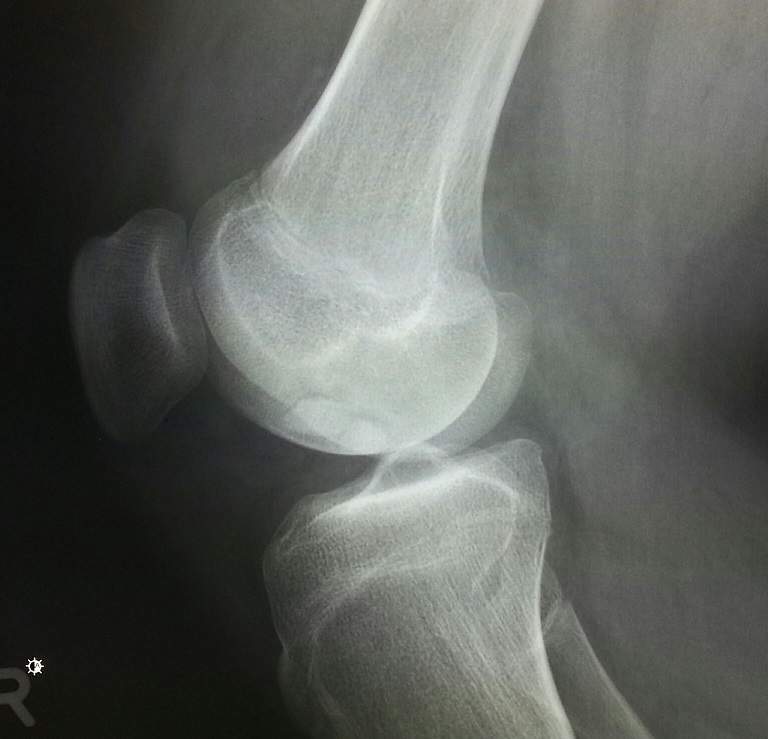 An 18-Year-Old With Right Knee Pain | Consultant360