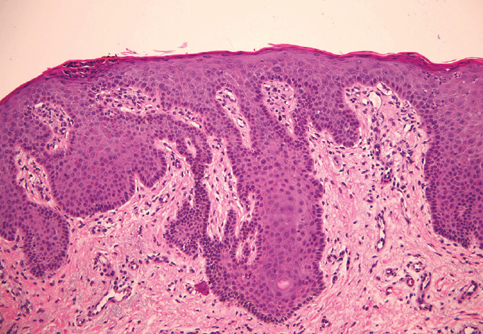 Erlotinib-Induced Psoriasis | Consultant360