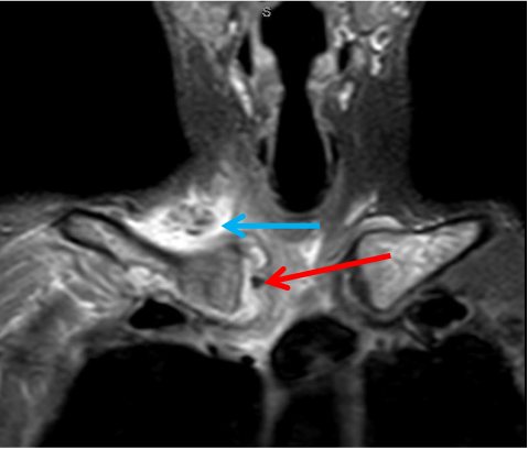 Nontypeable Haemophilus influenzae Sternoclavicular Joint Septic ...