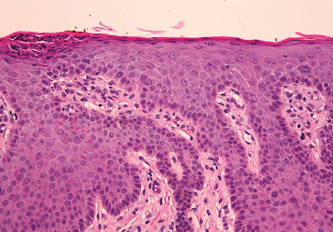 Erlotinib-Induced Psoriasis | Consultant360