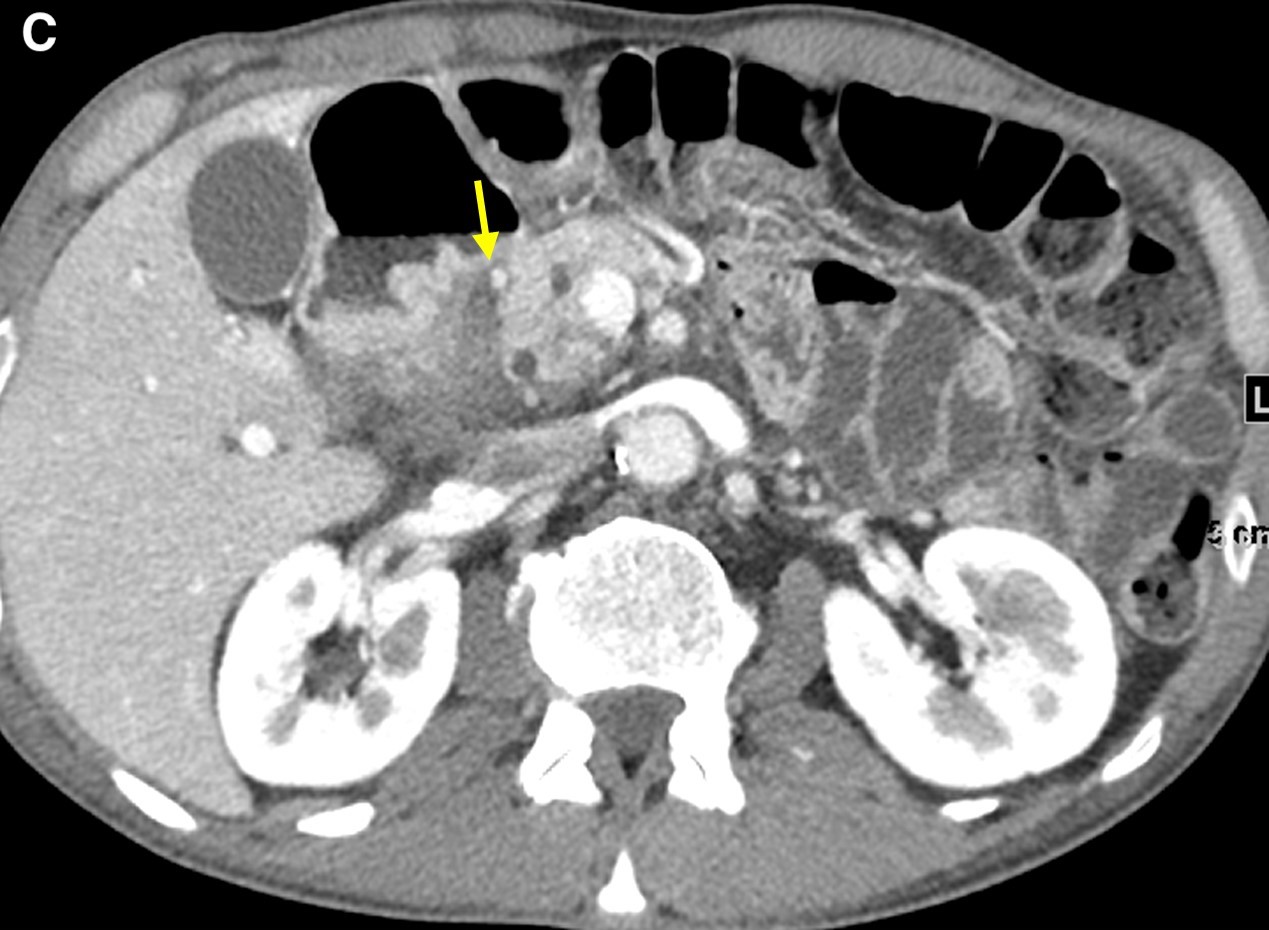 Groove Pancreatitis in a Patient With Recurrent Abdominal Pain and ...
