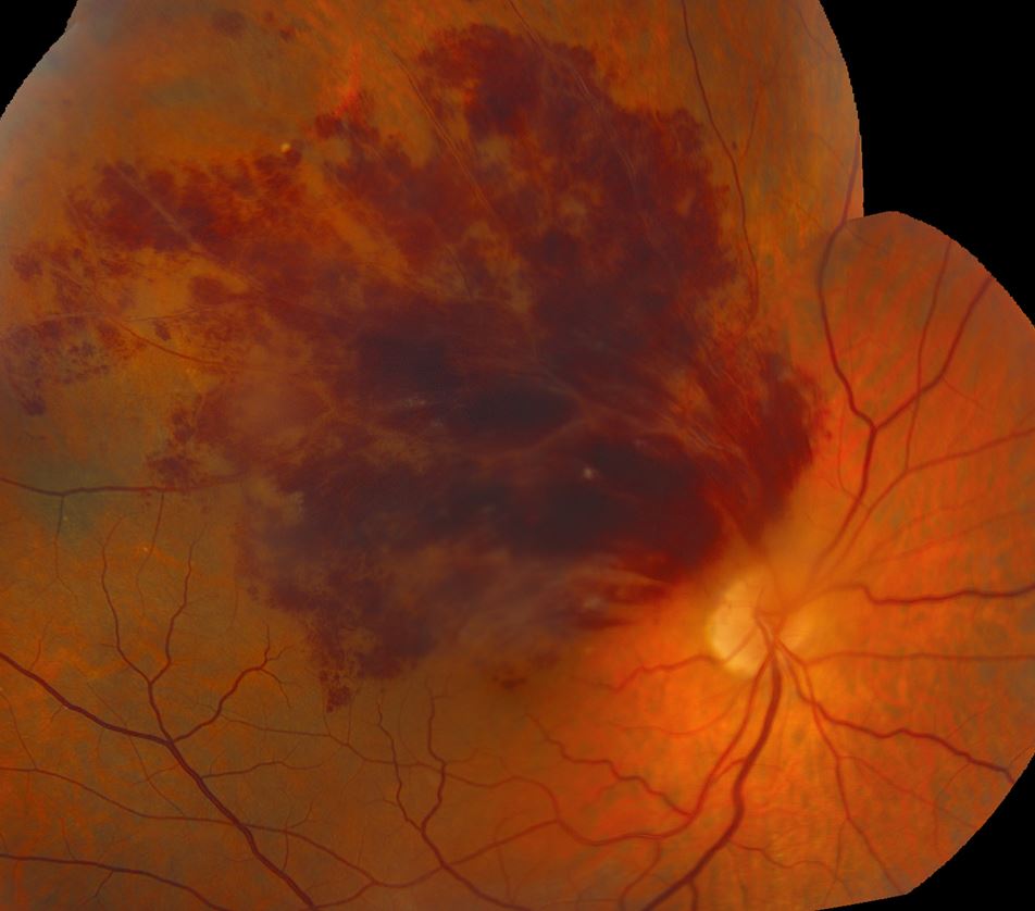 Branch Retinal Vein Occlusion in a Patient With Familial Hyperlipidemia ...